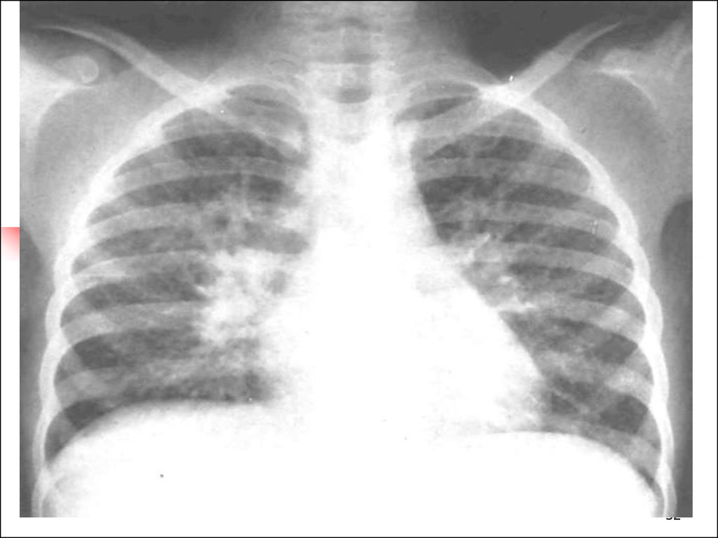 Pneumonia In Children Diagnostics And Treatment 