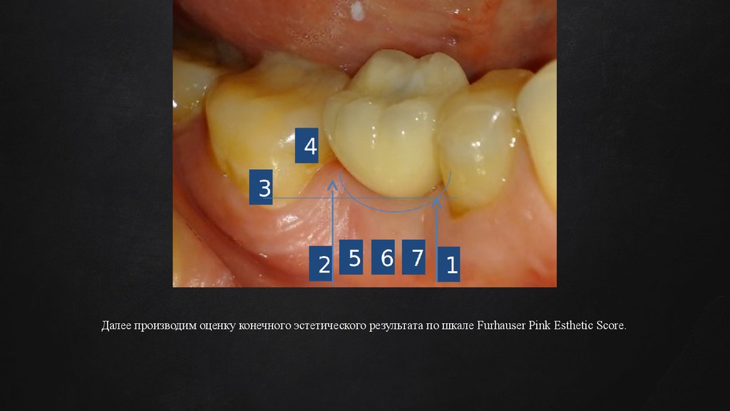 Particularitățile reabilitării estetice și funcționale a pacienților cu ...