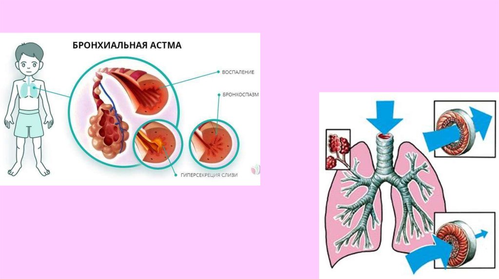 Бронхиальная астма - презентация онлайн