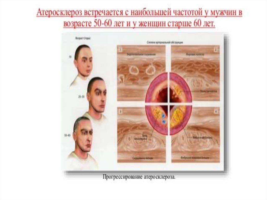 Профилактика атеросклероза - презентация онлайн